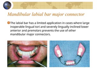 Mandibular Major Connectors1.ppt