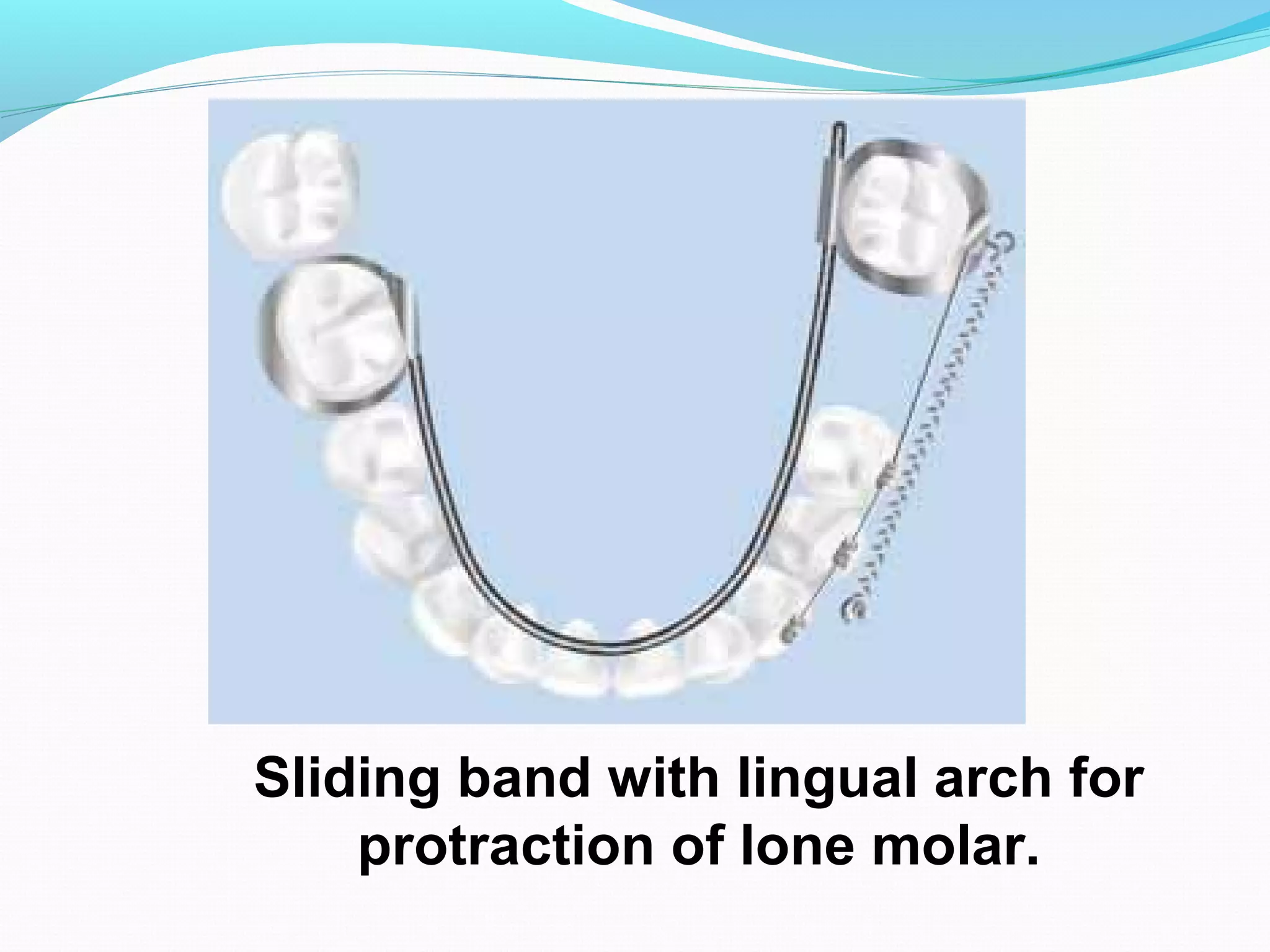 Mandibular molar protraction | PPT