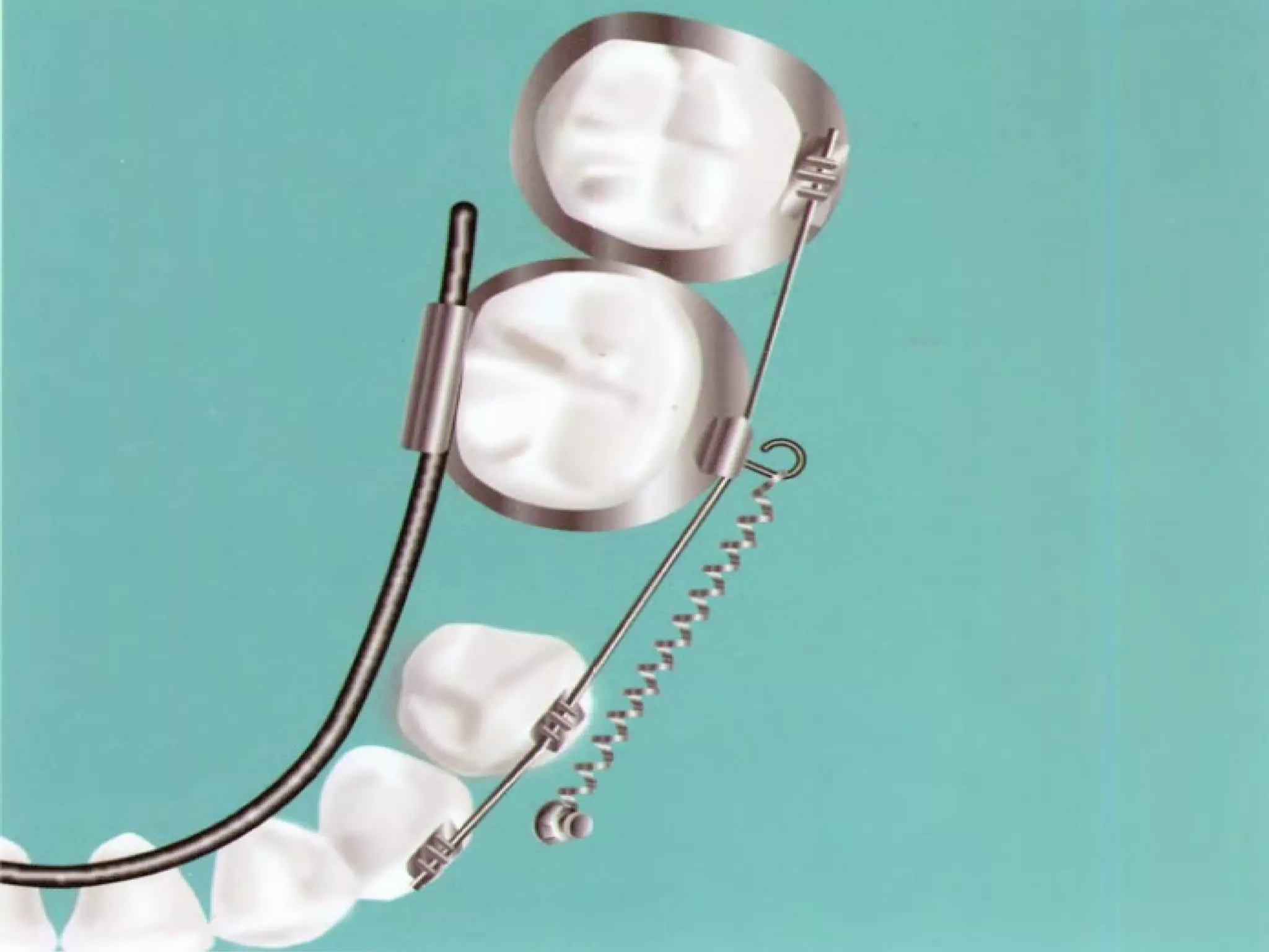 Mandibular molar protraction | PPT