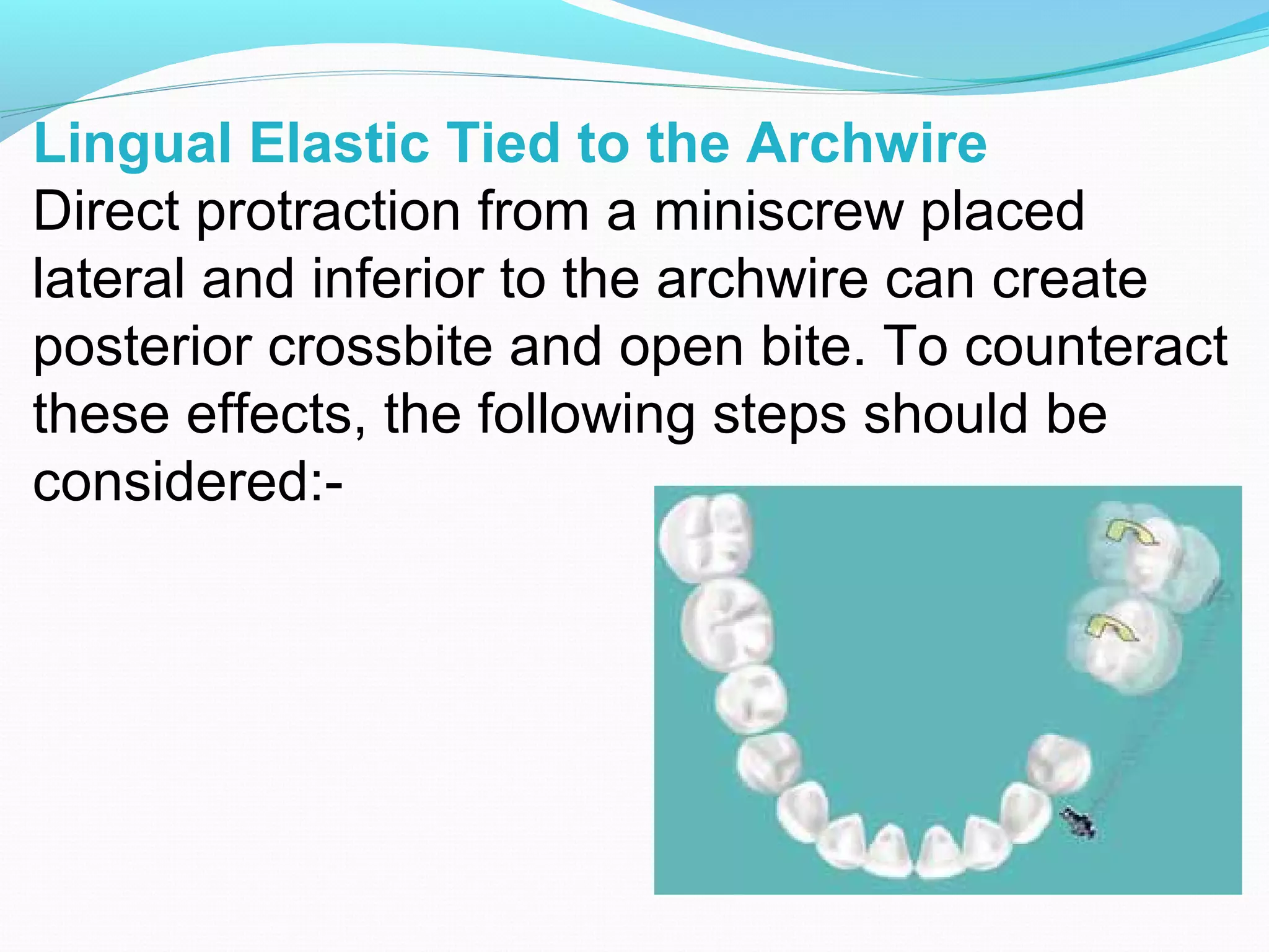 Mandibular molar protraction | PPT
