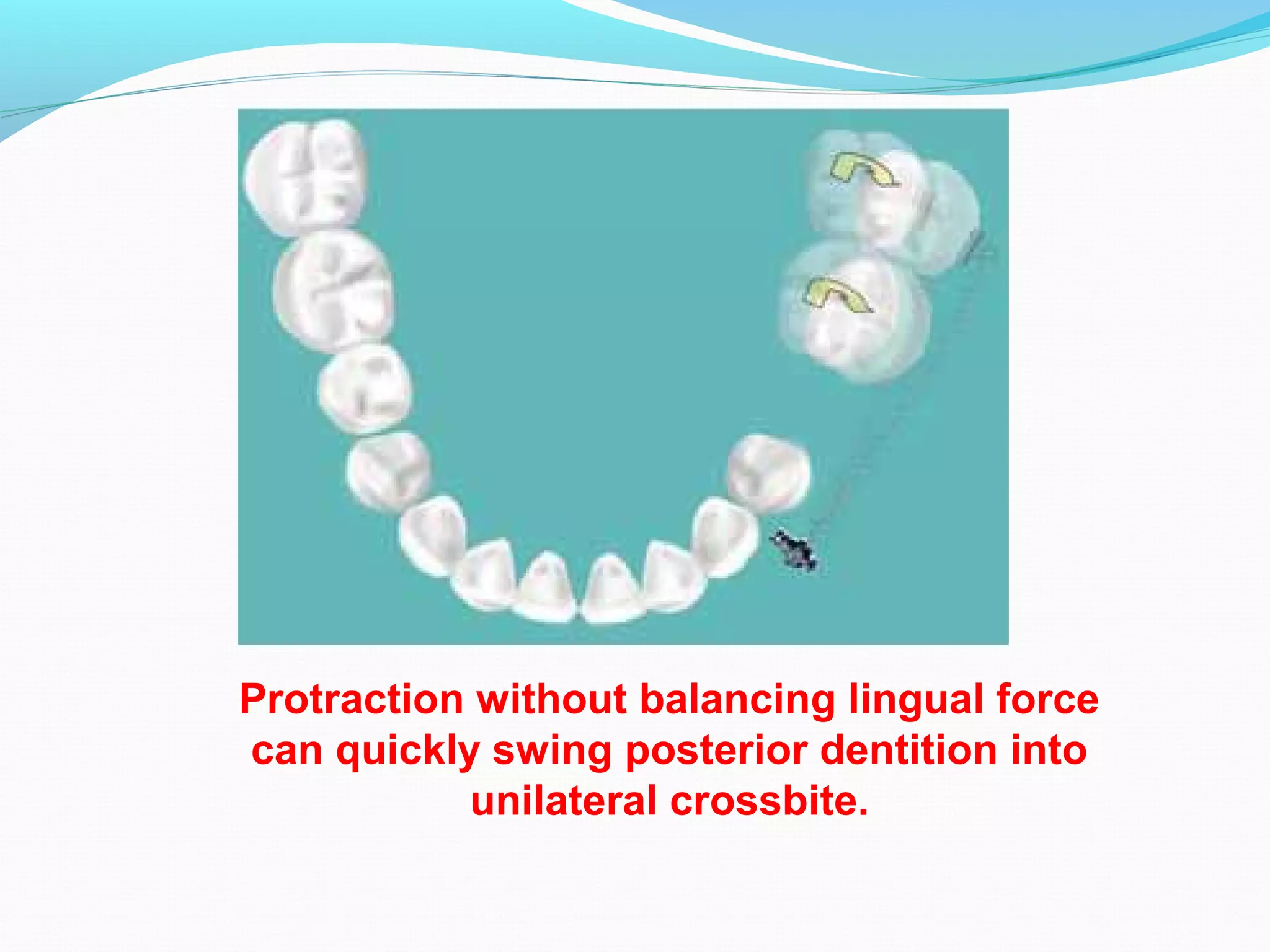 Mandibular molar protraction | PPT