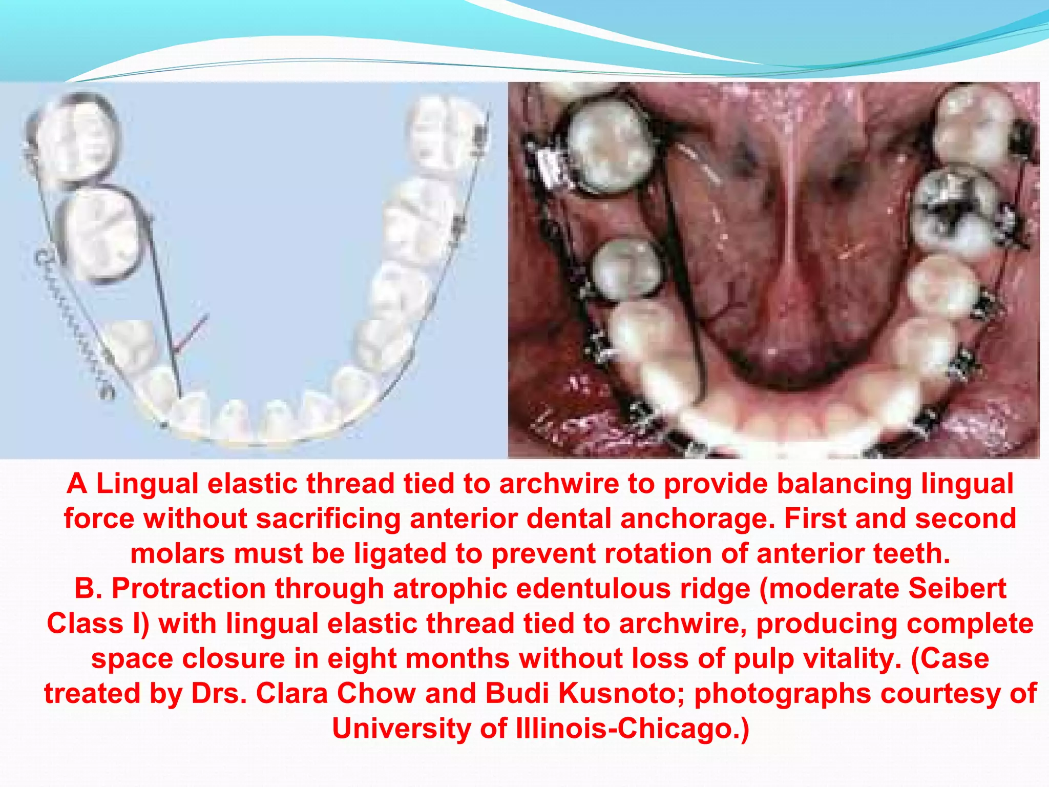 Mandibular molar protraction | PPT