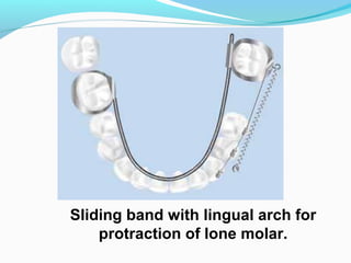 Mandibular molar protraction | PPT