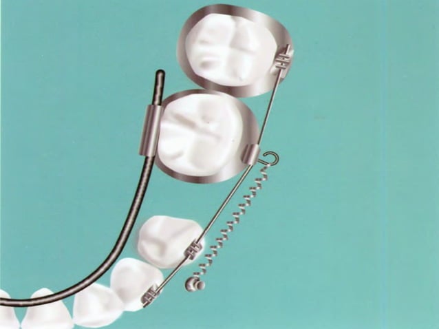 Mandibular molar protraction | PPT | Oral care | Personal Care