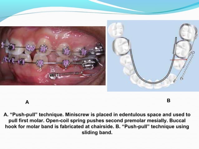 Mandibular molar protraction | PPT