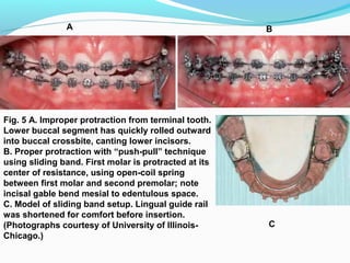 Mandibular molar protraction | PPT