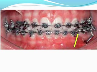 Mandibular molar protraction | PPT