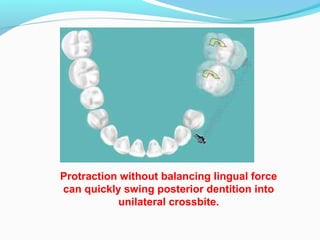 Mandibular molar protraction | PPT