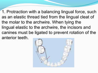 Mandibular molar protraction | PPT