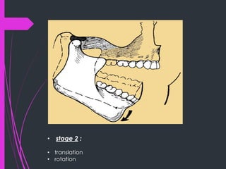 mechanics of Mandibular movement | PPTX
