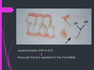 mechanics of Mandibular movement | PPTX