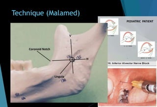 Mandibular nerve | PPTX