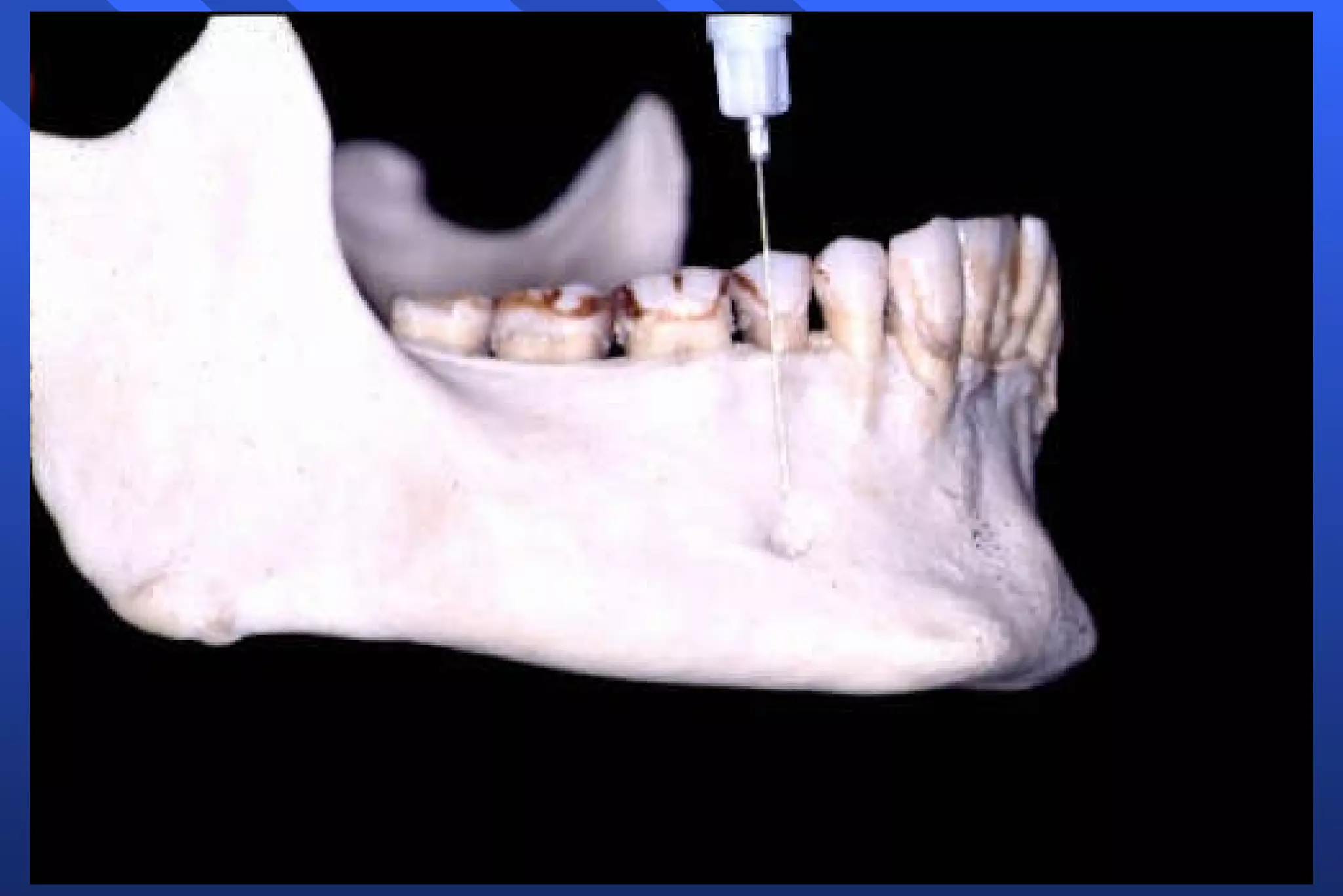 Mandibular nerve block (other techniques) | PPT