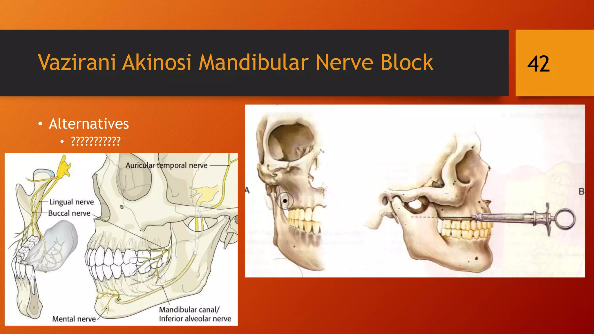 Mandibular Nerve Blocks Pptx