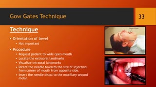 Mandibular nerve blocks | PPTX