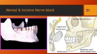 Mandibular nerve blocks | PPTX