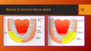 Mandibular nerve blocks | PPTX