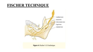 MANDIBULAR NERVE BLOCKS and techniques in dentistry | PPTX