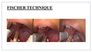MANDIBULAR NERVE BLOCKS and techniques in dentistry | PPTX