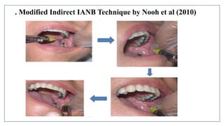 MANDIBULAR NERVE BLOCKS and techniques in dentistry | PPTX