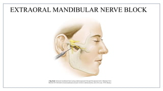 MANDIBULAR NERVE BLOCKS and techniques in dentistry | PPTX