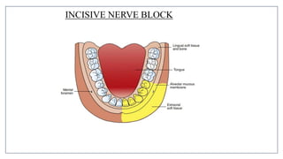 MANDIBULAR NERVE BLOCKS and techniques in dentistry | PPTX
