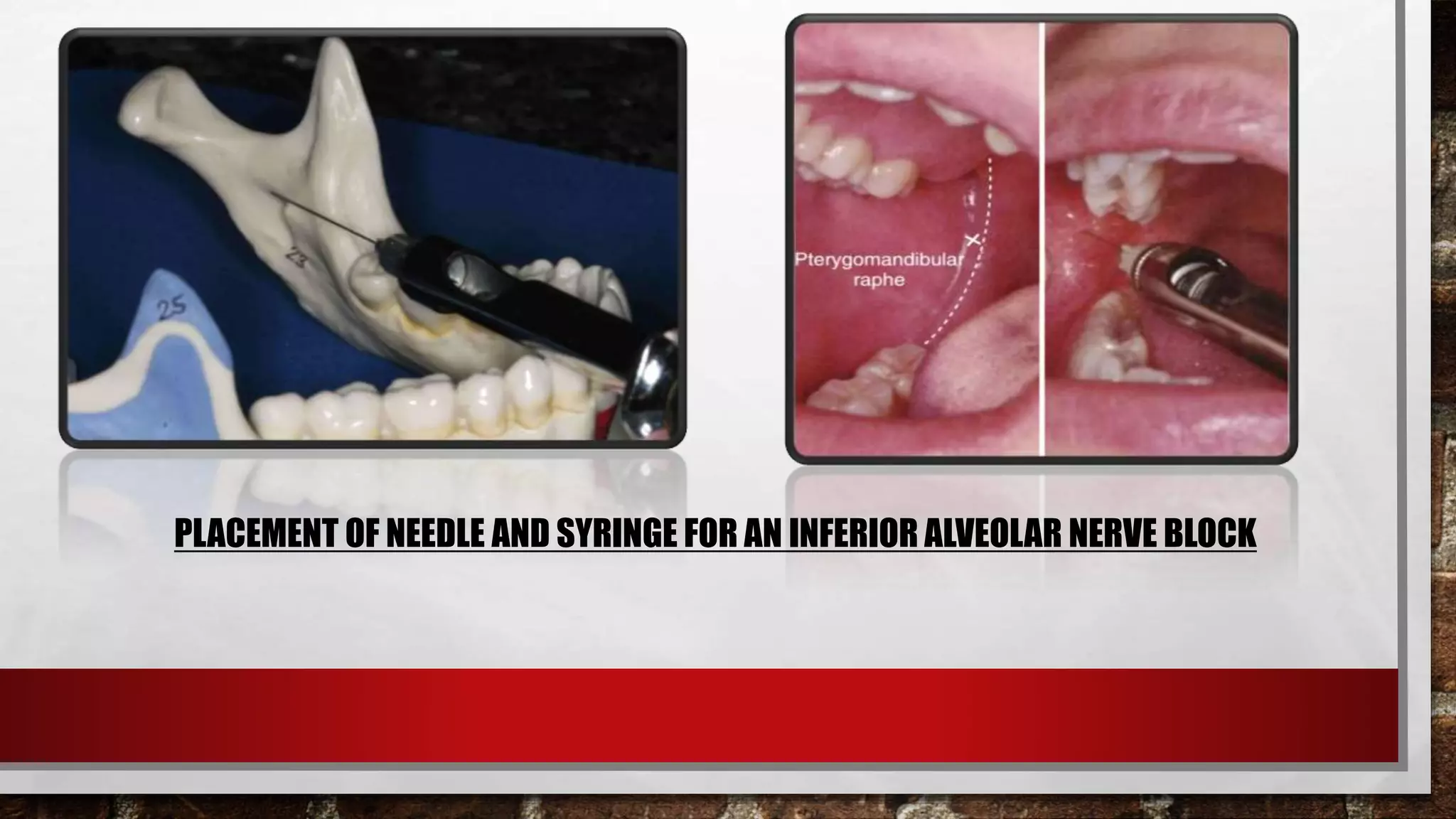 MANDIBULAR NERVE BLOCK TECHNIQUES | PPTX
