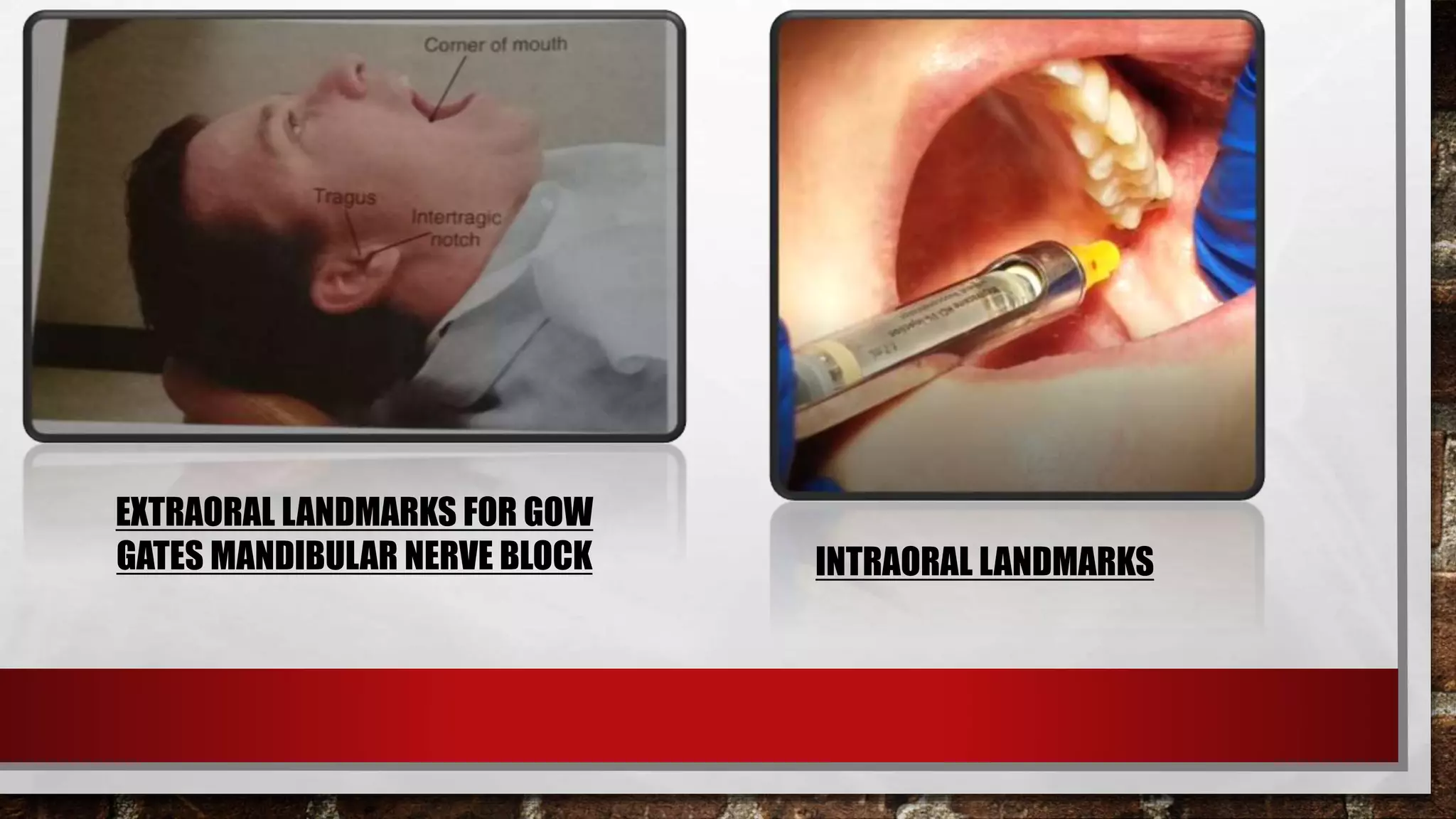 MANDIBULAR NERVE BLOCK TECHNIQUES | PPTX