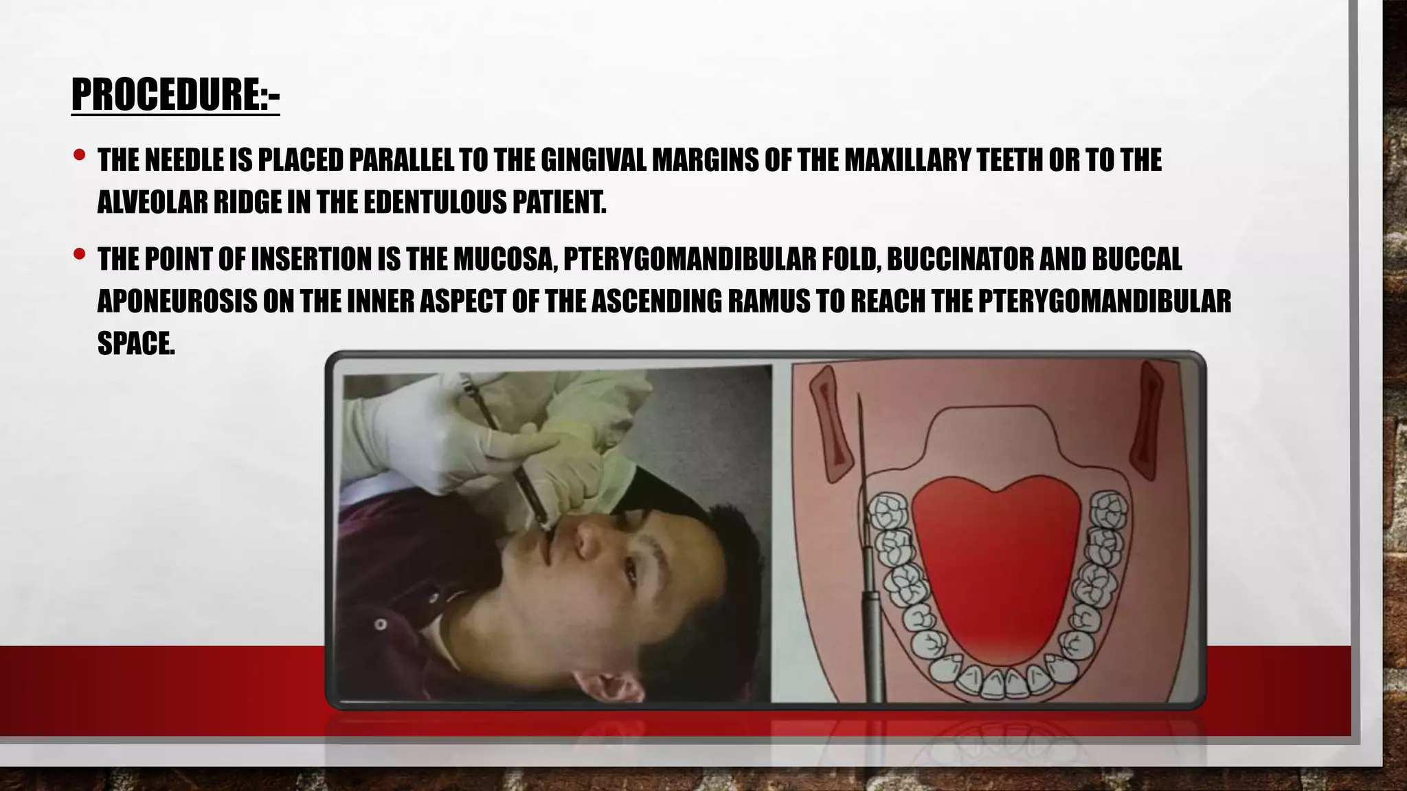 MANDIBULAR NERVE BLOCK TECHNIQUES | PPTX