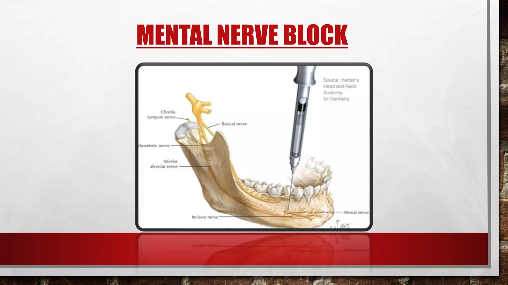 MANDIBULAR NERVE BLOCK TECHNIQUES | PPTX