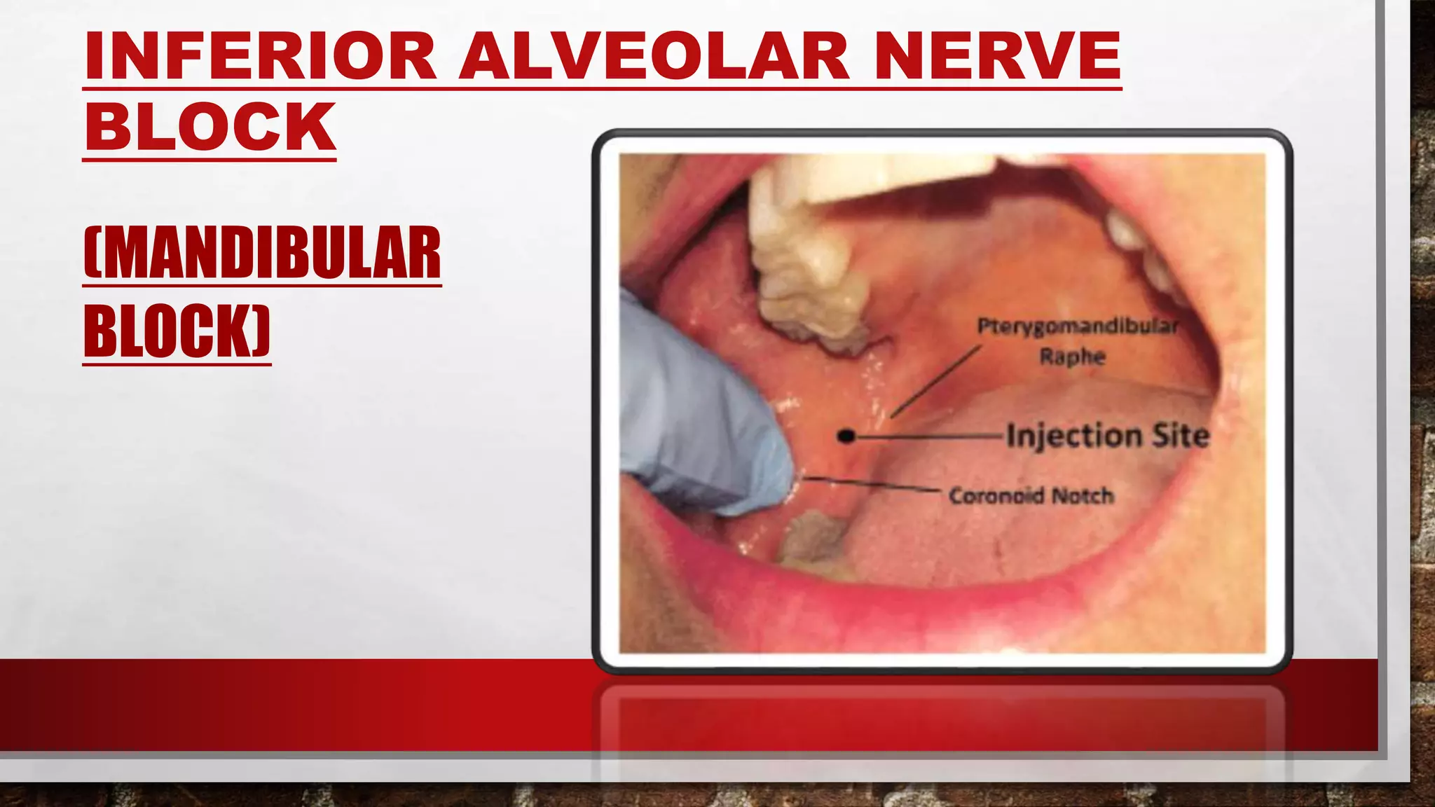 MANDIBULAR NERVE BLOCK TECHNIQUES | PPTX