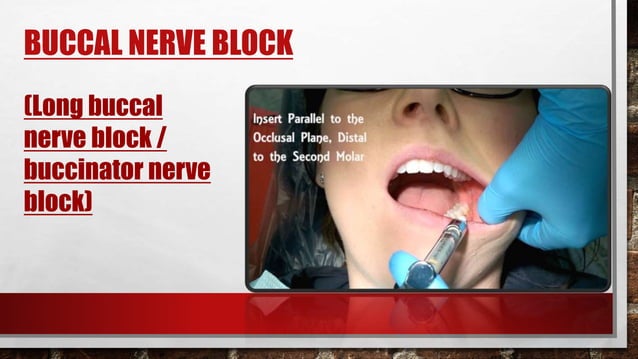 MANDIBULAR NERVE BLOCK TECHNIQUES | PPTX