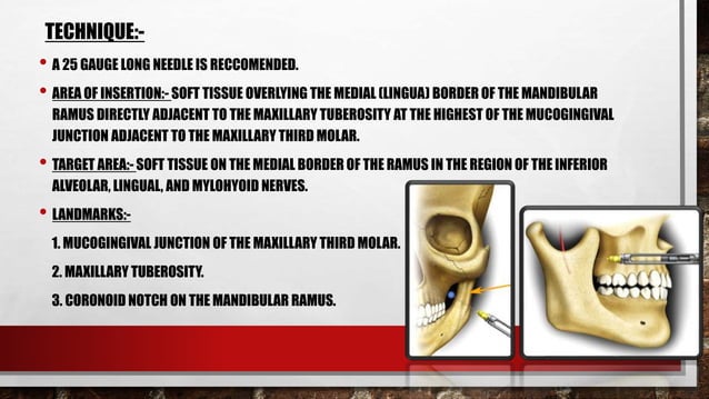 MANDIBULAR NERVE BLOCK TECHNIQUES | PPTX
