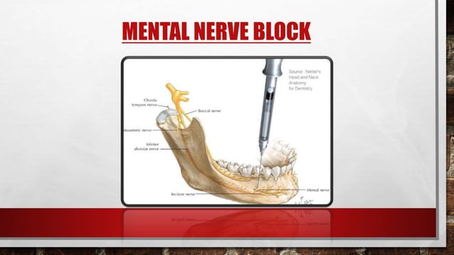 MANDIBULAR NERVE BLOCK TECHNIQUES | PPT