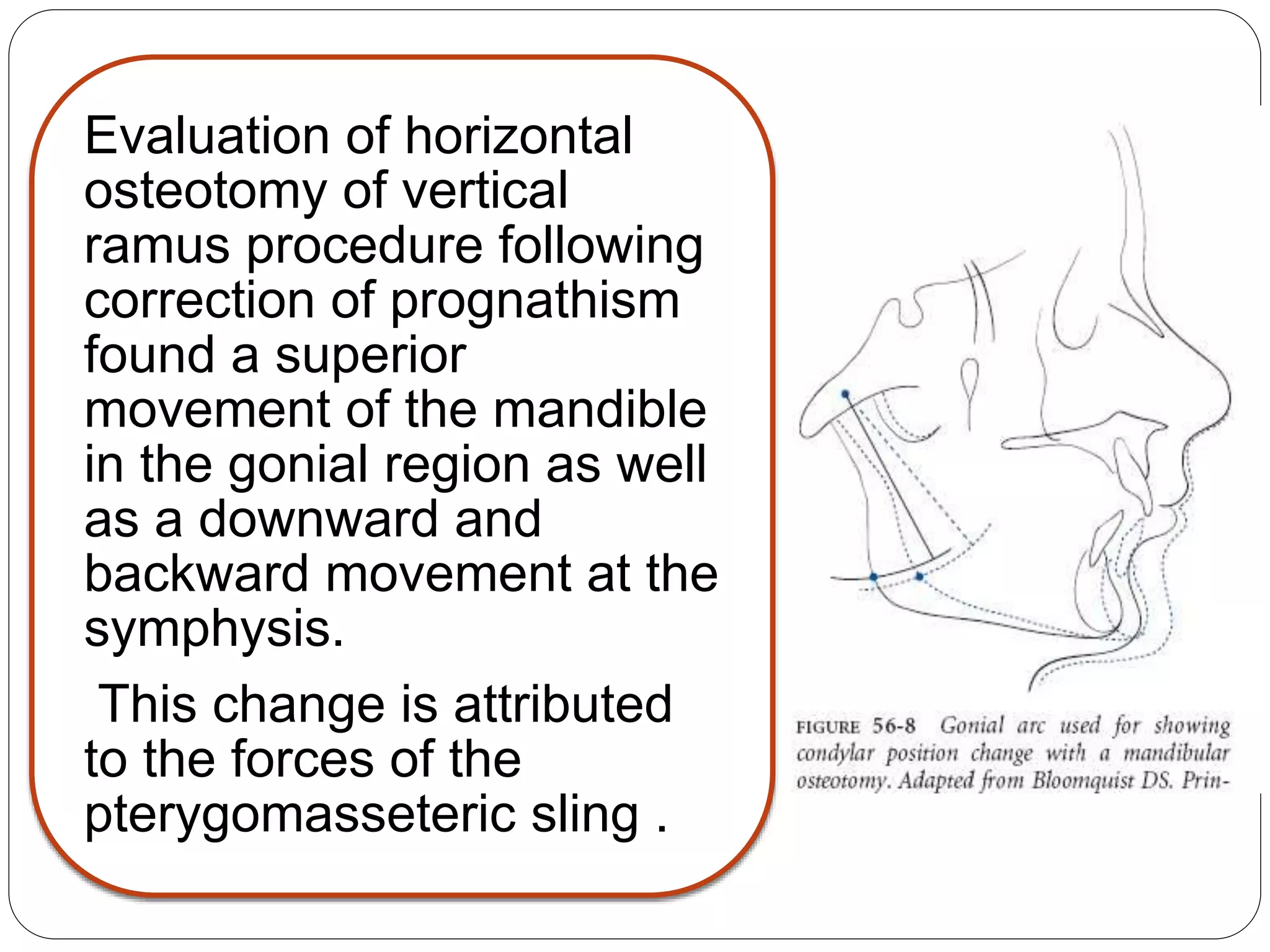 Mandibular orthognathic procedures 1- ih | PPTX