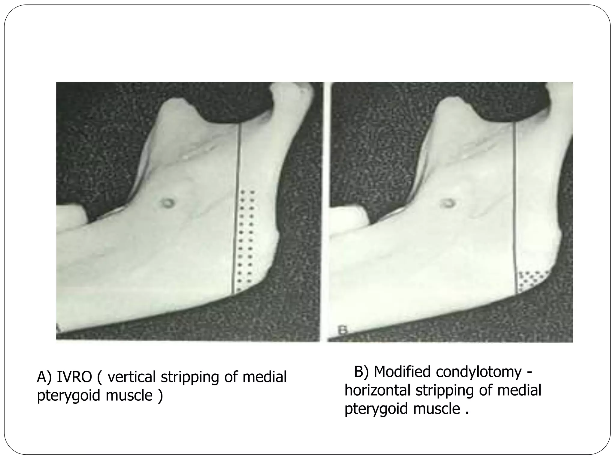 Mandibular orthognathic procedures 1- ih | PPTX