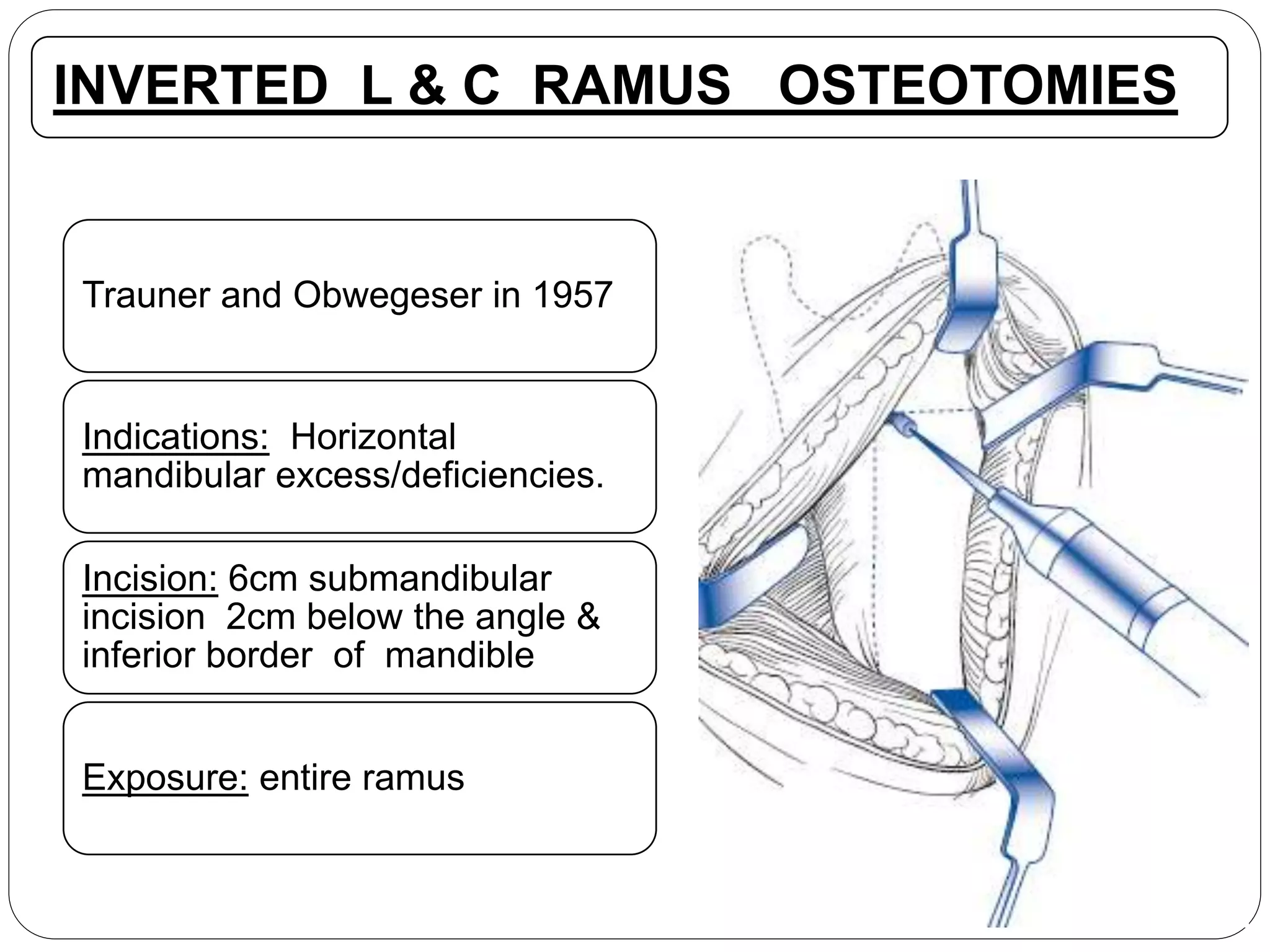 Mandibular orthognathic procedures 1- ih | PPTX