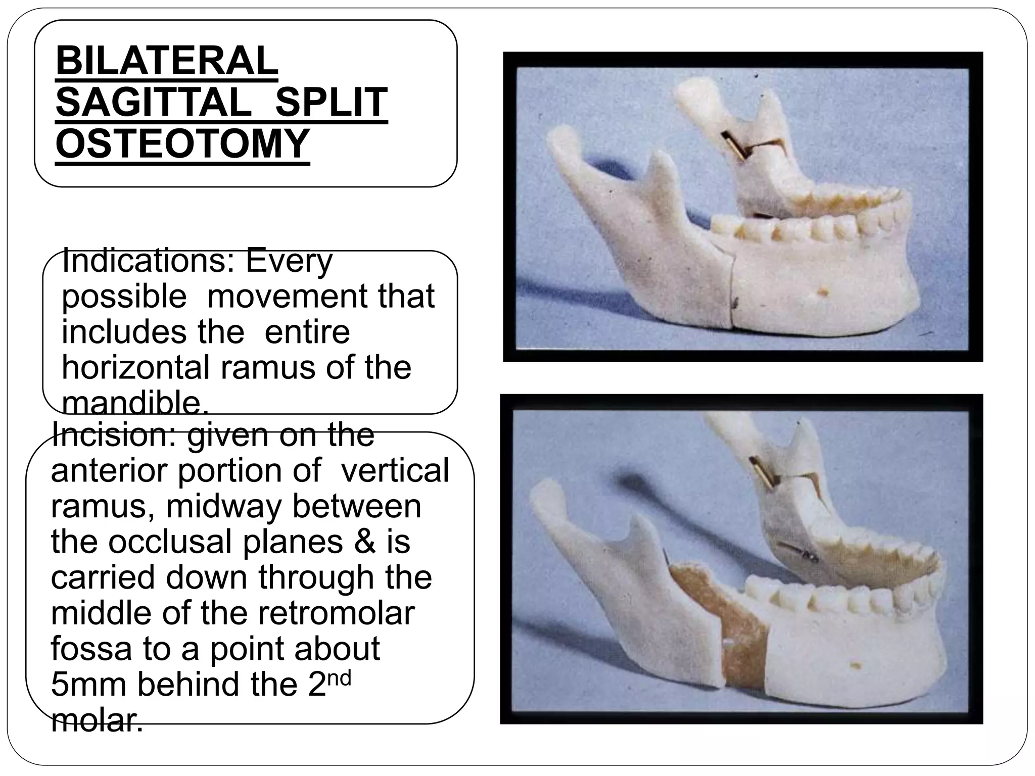 Mandibular orthognathic procedures 1- ih | PPTX
