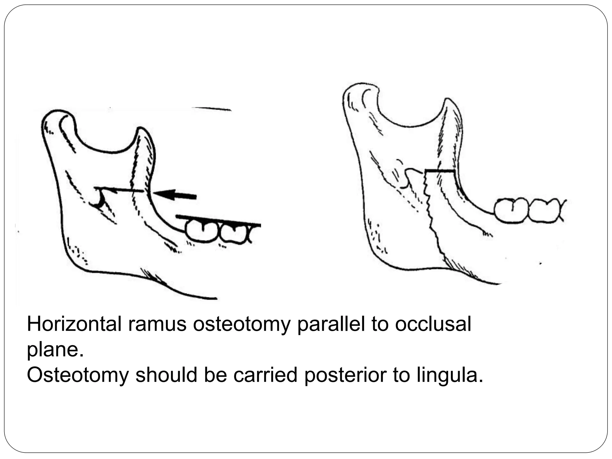 Mandibular orthognathic procedures 1- ih | PPTX