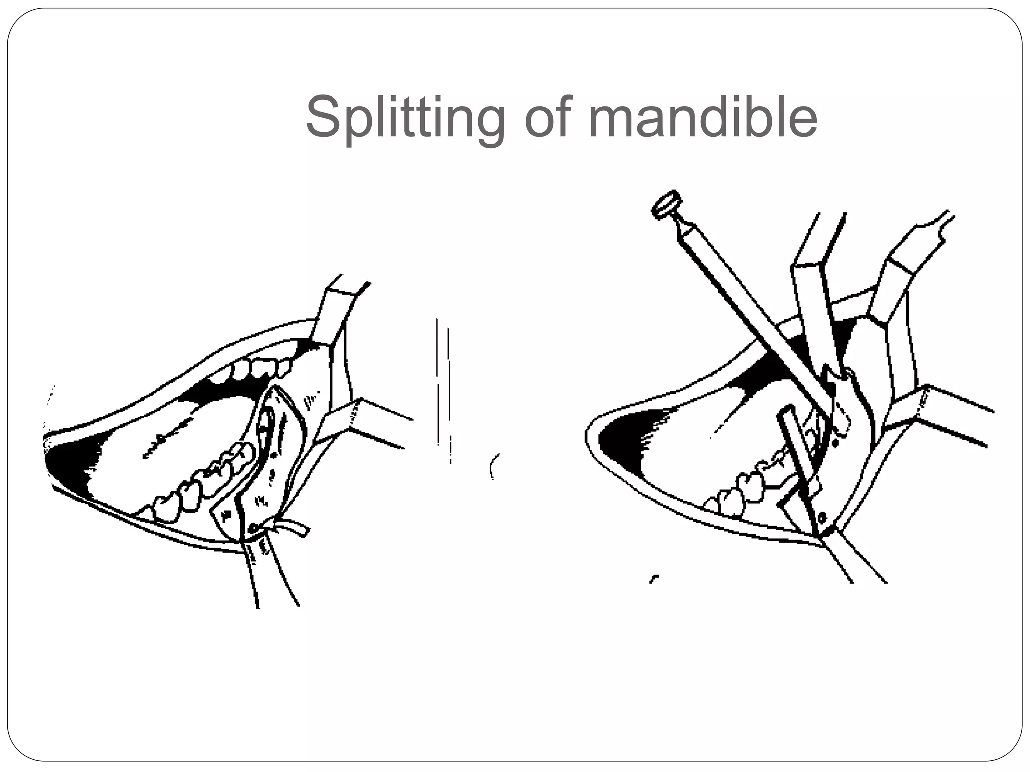 Mandibular orthognathic procedures 1- ih | PPTX