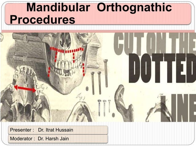 Mandibular orthognathic procedures 1- ih | PPTX | Dental Health ...