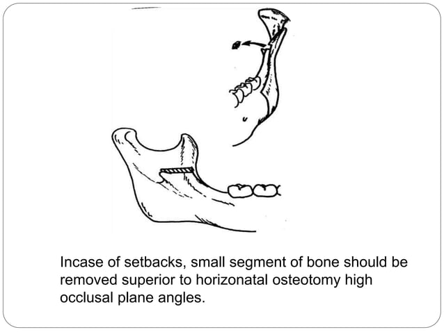 Mandibular orthognathic procedures 1- ih | PPTX | Dental Health ...