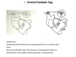 mandibular orthognathic procedures II- ih | PPTX