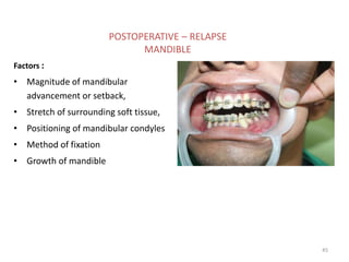 mandibular orthognathic procedures II- ih | PPTX