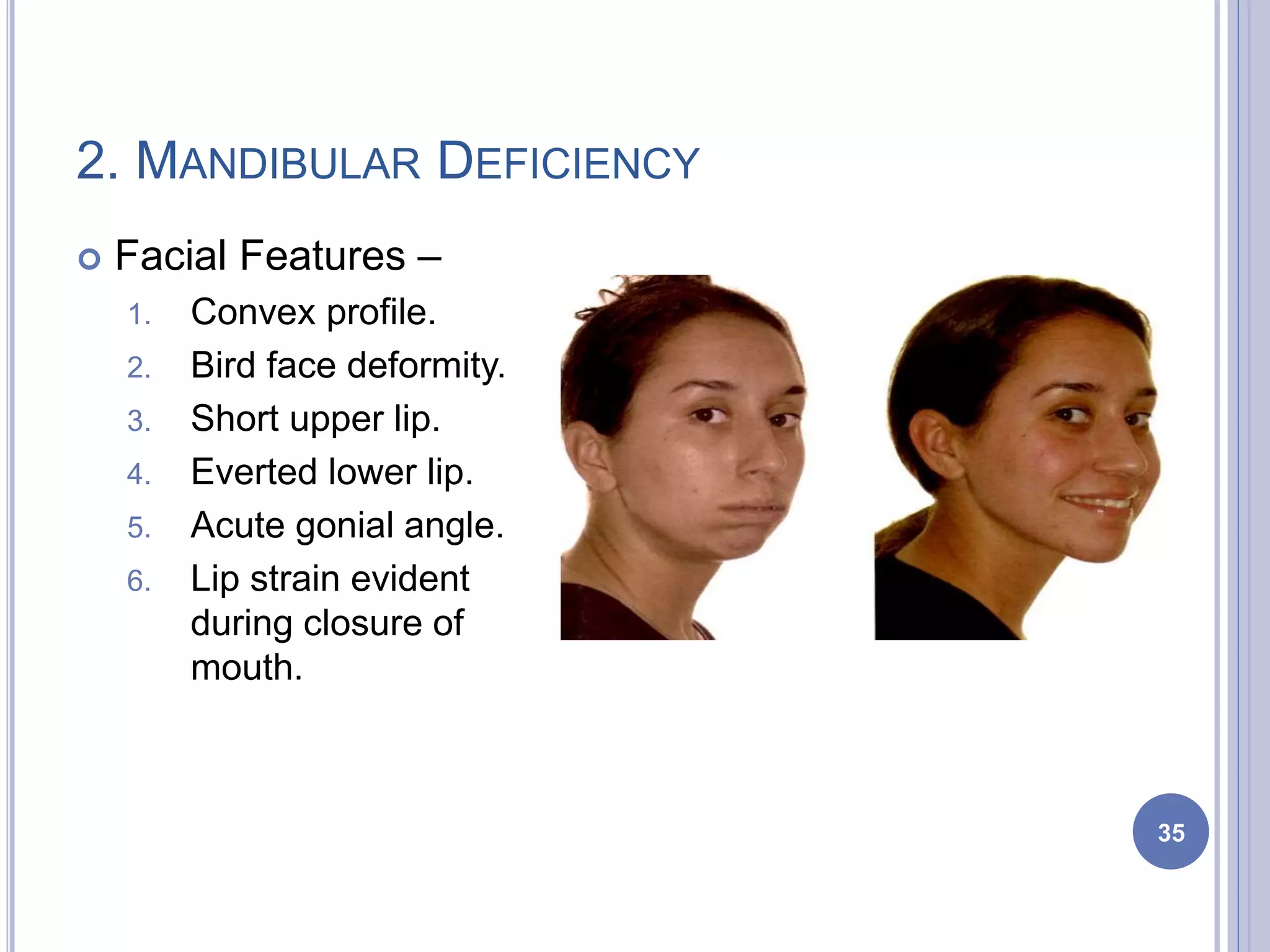 Mandibular orthognathic surgeries | PPTX