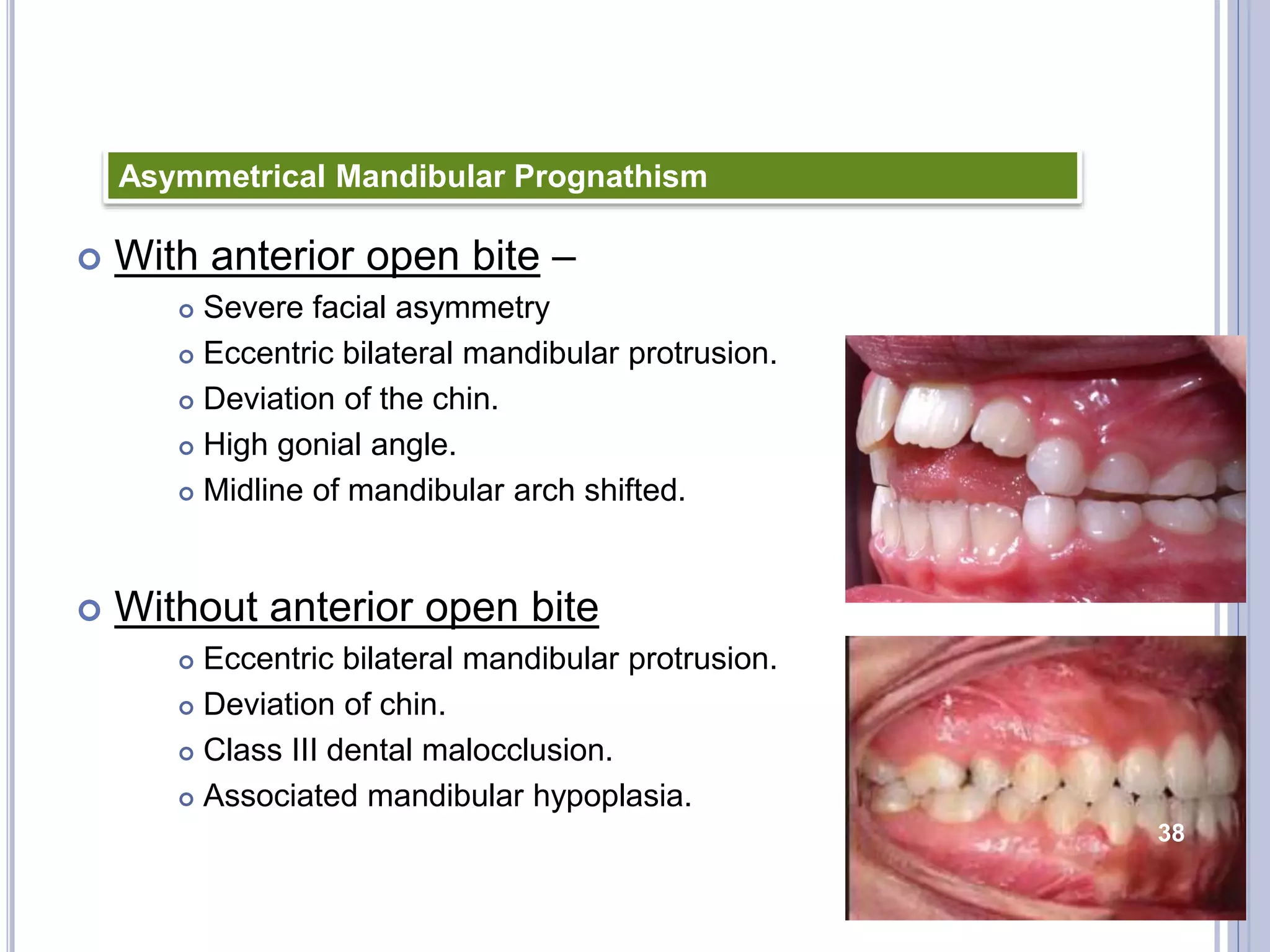 Mandibular orthognathic surgeries | PPTX
