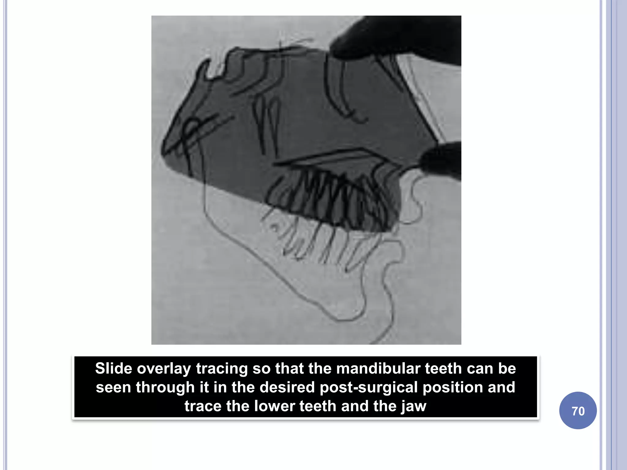 Mandibular orthognathic surgeries | PPTX