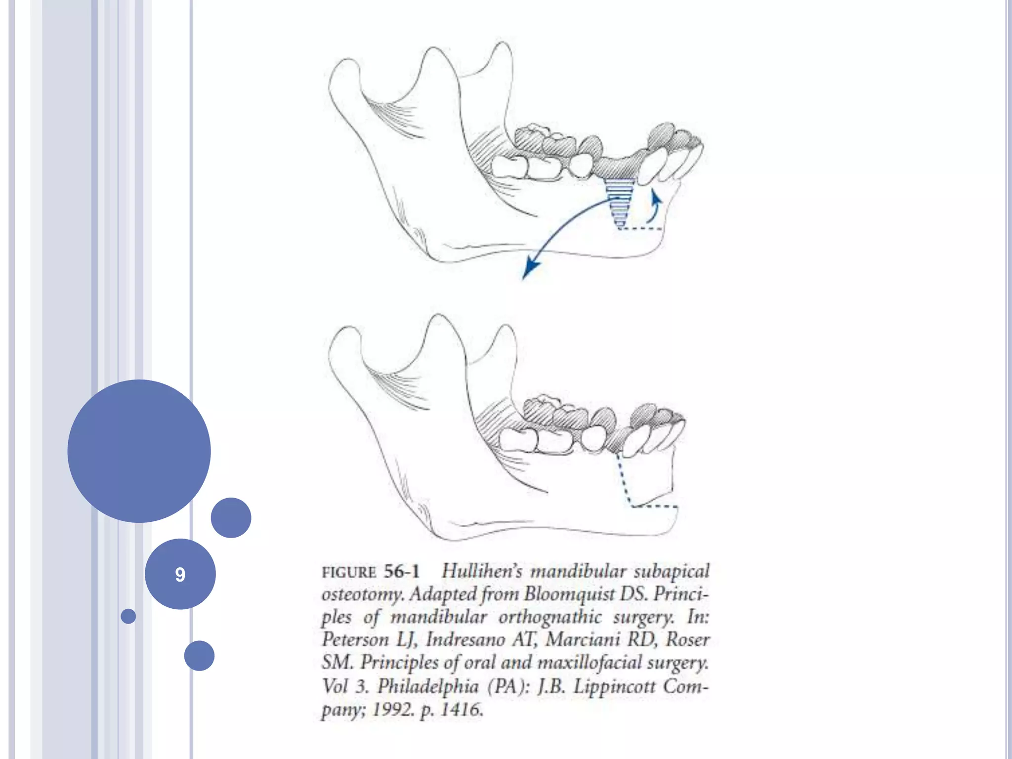 Mandibular orthognathic surgeries | PPTX