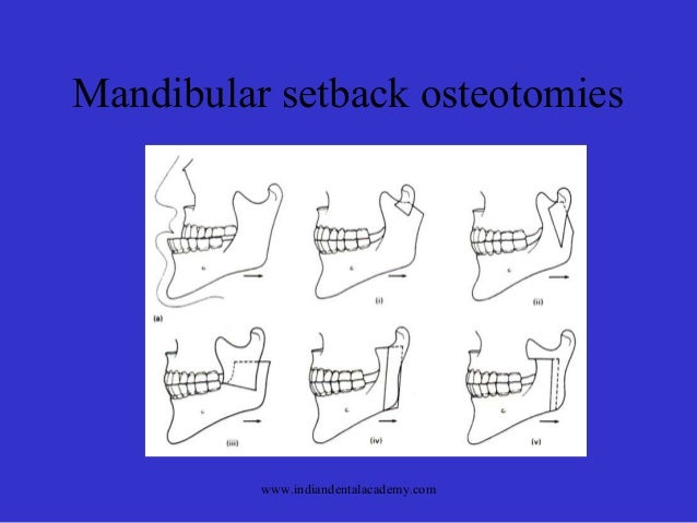 Mandibular osteotomies / oral surgery courses