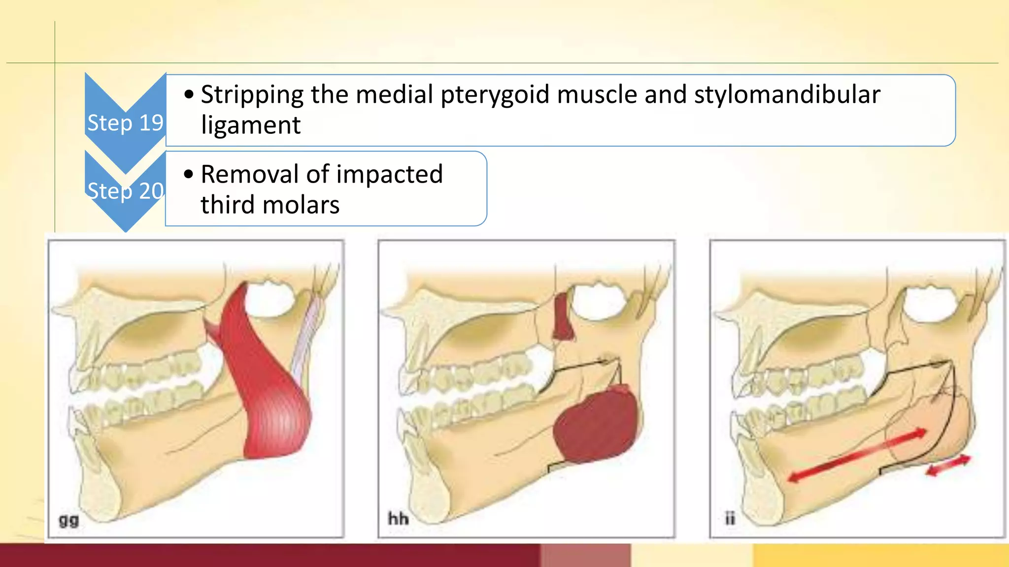Mandibular osteotomies | PPTX